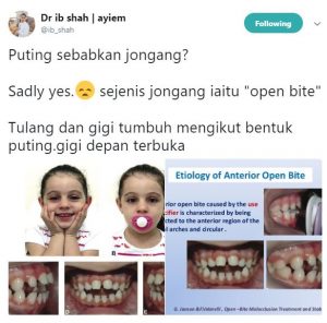 Doktor Ini Kongsi Risiko Gigi Anak Jongang Kalau Ada Tabiat Hisap ...