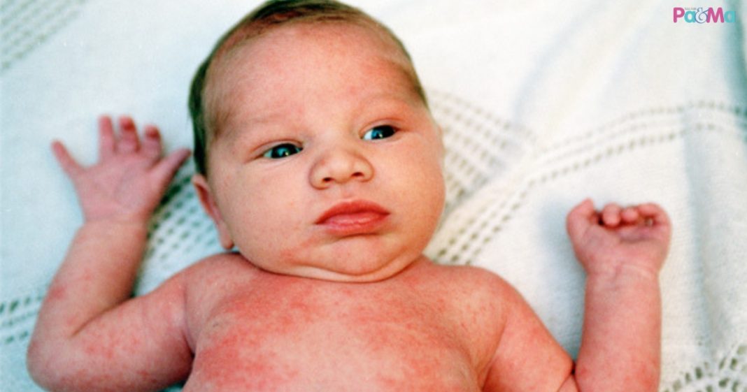 Malas Tukar Lampin Punca Bayi Hidap Ruam. Ketahui Masalah Kulit Lain ...