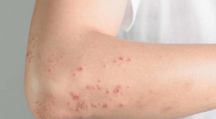 Kegatalan Kulit Melampau Lepas Bersalin Memang Tak Selesa! Bidan Kongsi ...