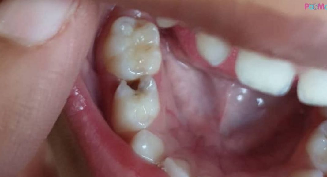 Anak Baru 5 Tahun, Gigi Berlubang Kena Cabut Ke Tampal? Ini Penjelasan ...