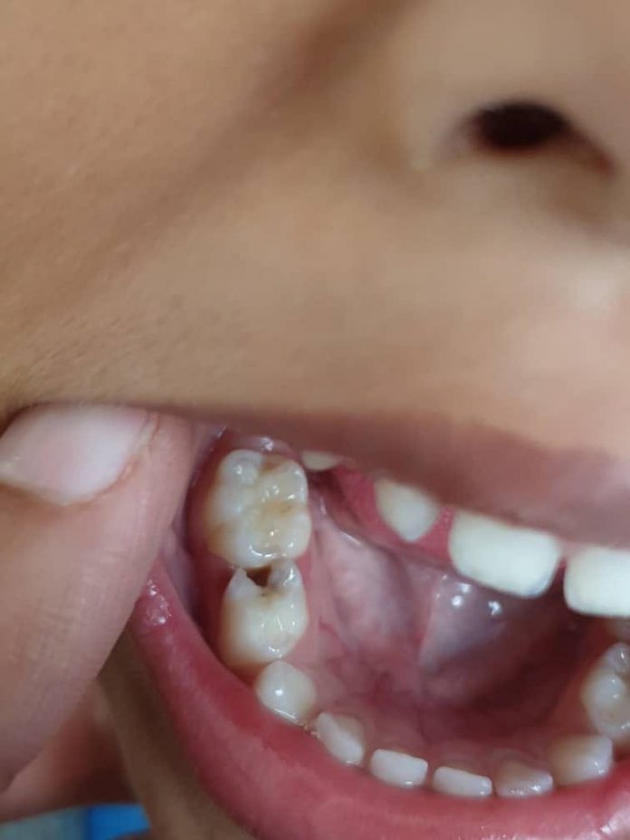 Anak Baru 5 Tahun, Gigi Berlubang Kena Cabut Ke Tampal? Ini Penjelasan Doktor