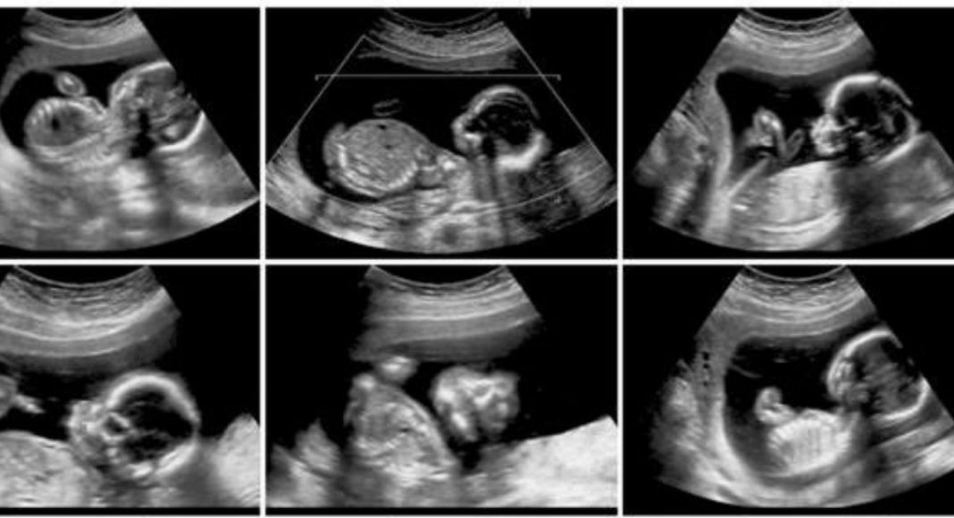 Detail Scan Doktor Tengok A-Z Perkembangan Bayi. Waktu Terbaik ...