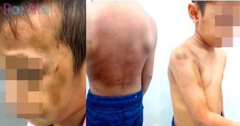 Didera Ibu dan Teman Lelaki, Kanak-kanak Lima Tahun Lebam Hampir Seluruh Badan