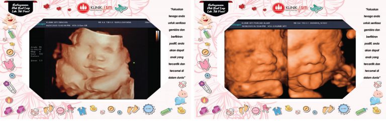 Bayi Menyorok Masa Scan? Banyakkan Minum Air Kosong Sebelum Buat ...