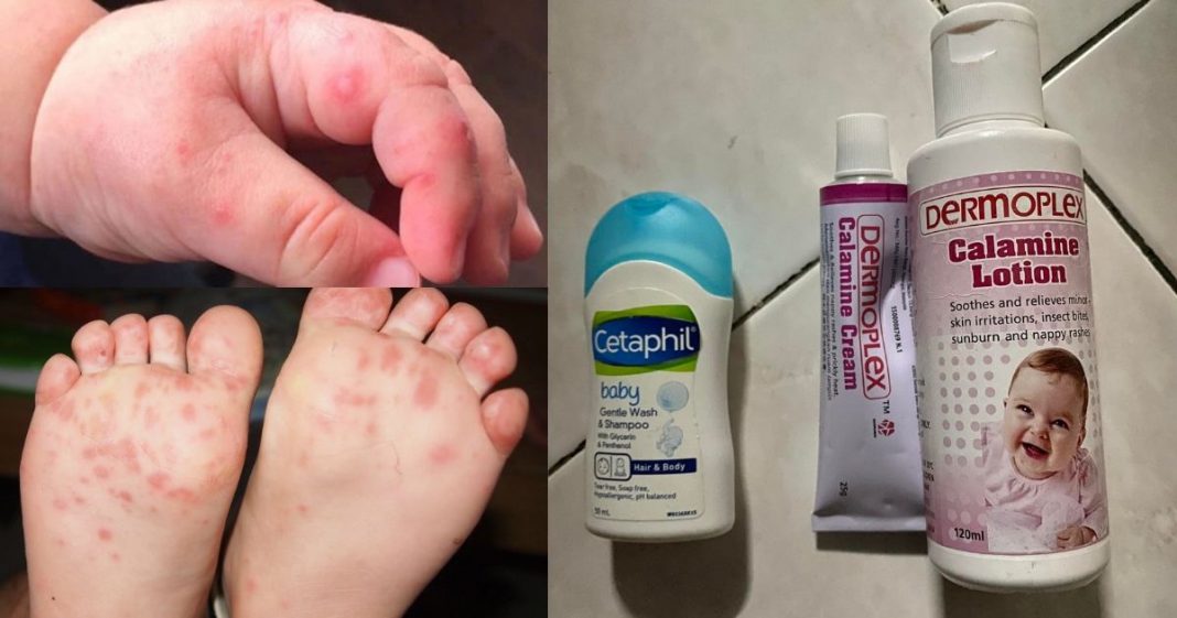 Anak Kena HFMD, Bintik Air Cepat Kecut & Kering, Ibu Ini Kongsi Cara ...