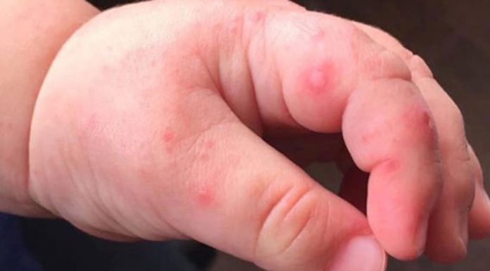 Anak Kena HFMD, Bintik Air Cepat Kecut & Kering, Ibu Ini Kongsi Cara ...
