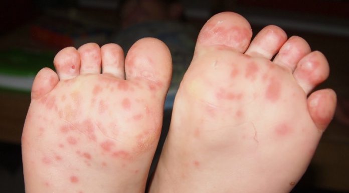 Anak Kena HFMD, Bintik Air Cepat Kecut & Kering, Ibu Ini Kongsi Cara ...