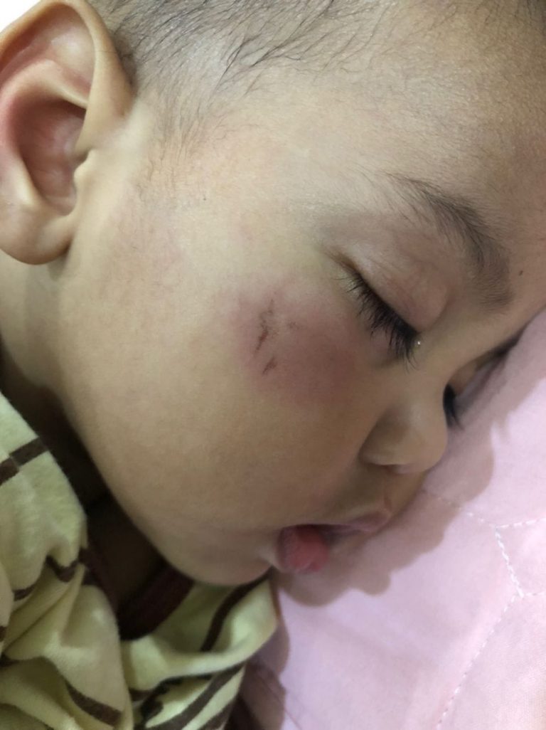 Bapa Kesal Tubuh Anak Penuh Luka & Ada 8 Kesan Gigitan Masa Ambil Dari ...