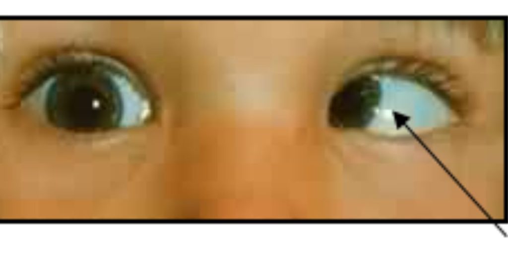 Mata Juling Mungkin Dikaitkan Dengan Keturunan, Ini Rawatan Sesuai ...