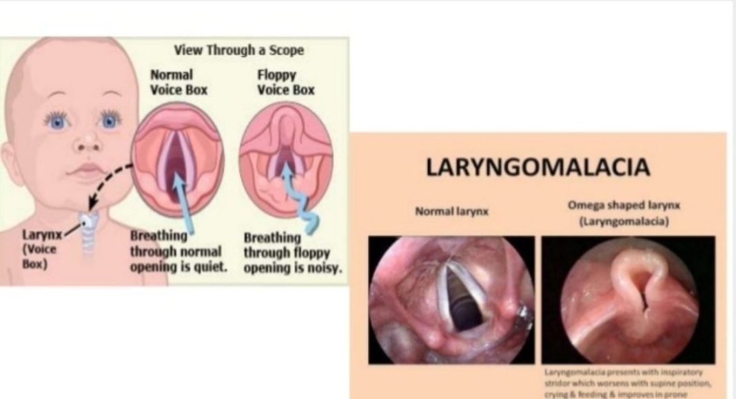 Bunyi Nafas Makin Kuat, Awas Anak Anda Mungkin Mengalami Laryngomalacia