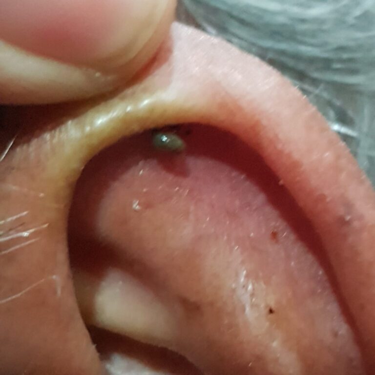 Sengkenit Bila 'Melekat' Pada Kulit Memang Bahaya, Boleh Sebabkan Muka ...