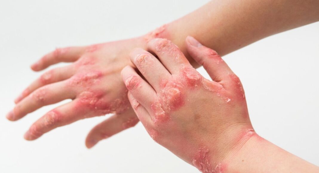 Sengkenit Bila 'Melekat' Pada Kulit Memang Bahaya, Boleh Sebabkan Muka ...